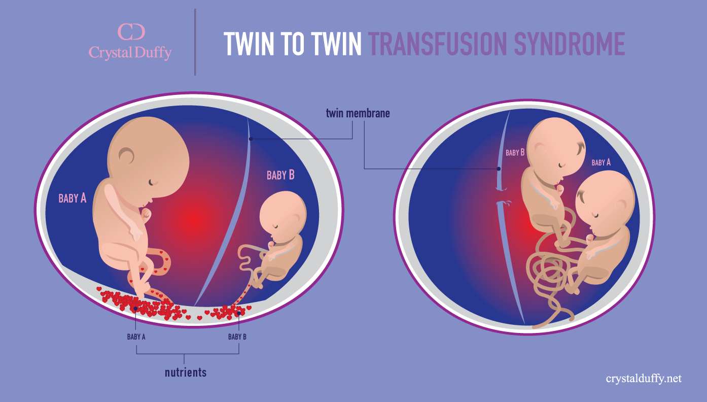fetus-TTT-image-ver5 - Crystal Duffy